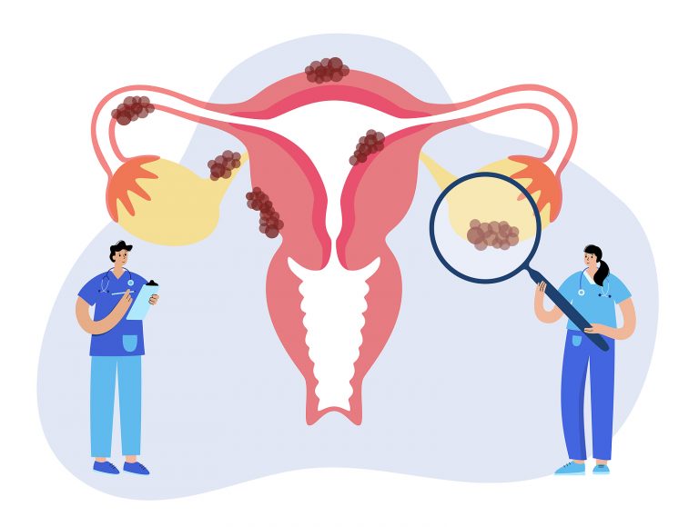 What Is Chocolate Cyst (Ovarian Endometrioma)?