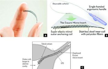 Removal Of Essure Contraceptive Device